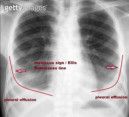 Meniscus sign , Pleural effusion in chest x-ray (1396660475) - 게티이미지뱅크