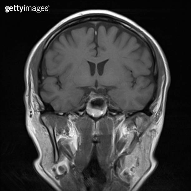normal brain MRI images 이미지 (1430512447) - 게티이미지뱅크