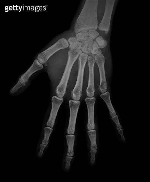 x ray image of normal hand 이미지 (1432888541) - 게티이미지뱅크