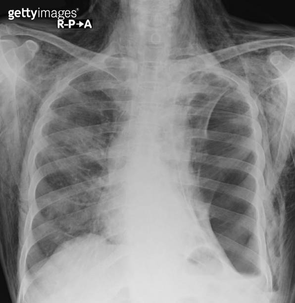 Subcutaneous emphysema chest x ray 이미지 (1410007366) - 게티이미지뱅크 Subcutaneous emphysema chest x ray 이미지 (1410007366) - 게티이미지뱅크