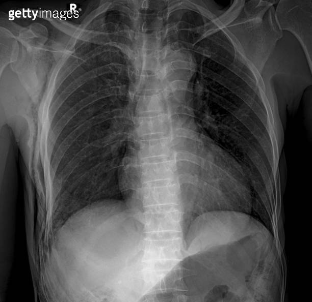 Subcutaneous emphysema chest x ray 이미지 (1410924368) - 게티이미지뱅크 Subcutaneous emphysema chest x ray 이미지 (1410924368) - 게티이미지뱅크