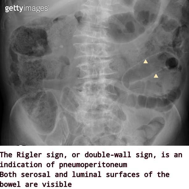 Rigler sign is indication of pneumoperitoneum, abdomen xray 이미지 ...