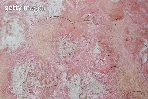 scab. skin disease. psoriasis. dermatitis. red rash. human skin ...