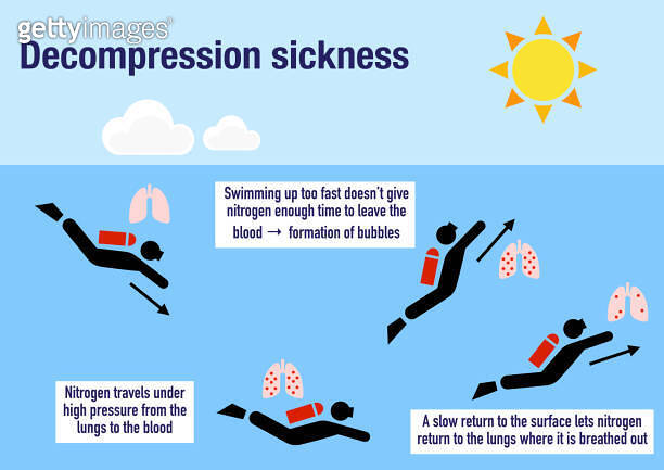 The decompression sickness explained (1385532851) 일러스트, 무료 일러스트 - 게티이미지뱅크