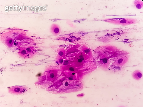 Pap's smear: pap stain Microscopic view show High-grade squamous ...