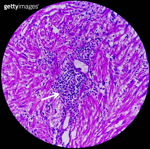 Prostate Cancer: Microscopic image of prostatic tissue, adenocarcinoma ...