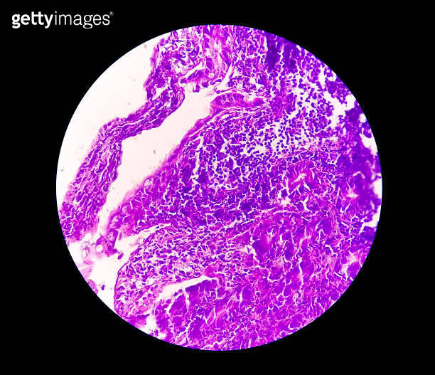 Tissue from terminal ileum: Chronic nonspecific ileitis or inflammation ...
