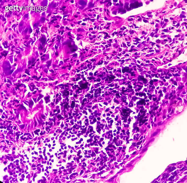 Tissue from terminal ileum: Chronic nonspecific ileitis or inflammation ...