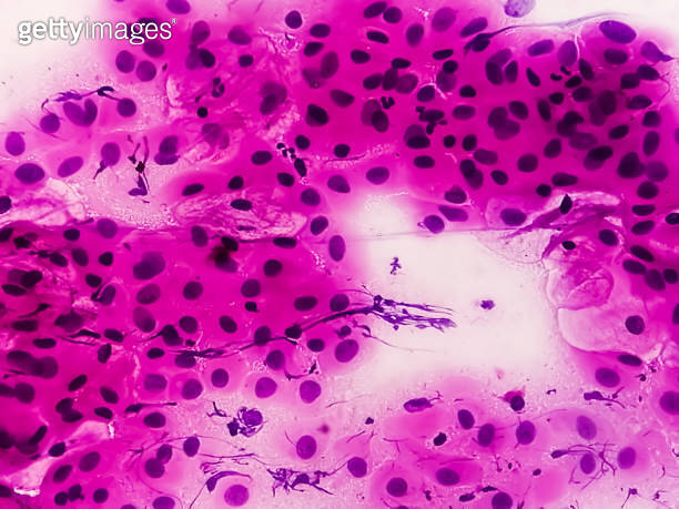 Pap's smear pap stain Microscopic 100x Zoom show High-grade squamous ...