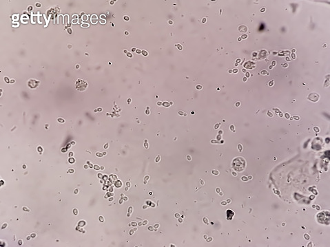 Budding yeast cells, urinalysis (urinary tract infections), analyze by ...