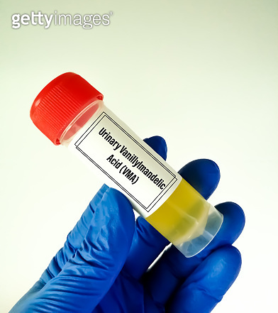 Urine sample for 24 hours Vanillylmandelic acid (VMA) Test for the ...