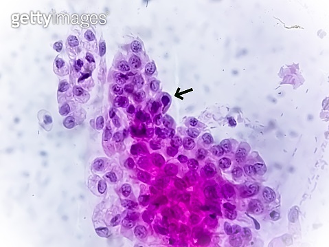Microscopic view of Trichomonas vaginalis in pap smear with few acute ...