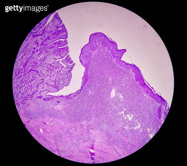 Histological slide under microscopy showing Pedunculated squamous ...
