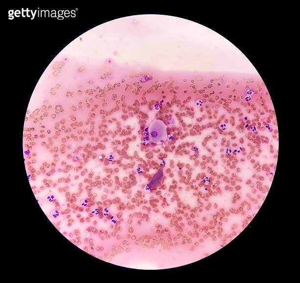 Pap's smear: Microscopic view of vault smear showing.adiation induced ...