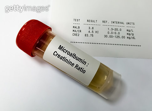 Urine Sample for Urine ACR or microalbumin creatinine Ratio. Chronic ...