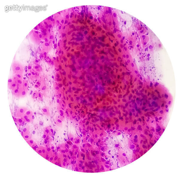Pap's smear pap stain Microscopic 40x Zoom show High-grade squamous ...