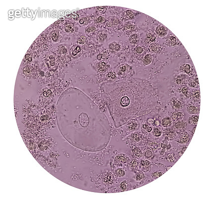 Microscopic image show plenty Pus cells with few Epithelial cells ...
