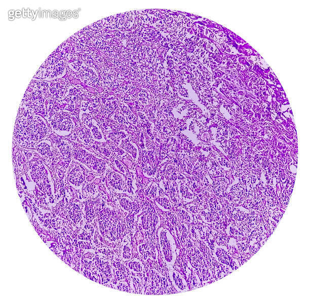 Bladder Cancer: High grade transitional cell carcinoma (TCC ...