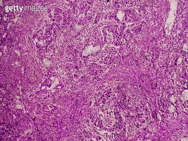 Bladder Cancer: High grade transitional cell carcinoma (TCC ...