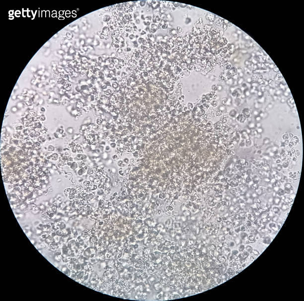 Microscopic image show plenty Pus cells. Urinary tract infection ...