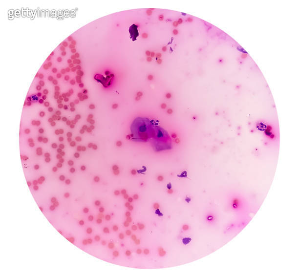 Pap's smear: Microscopic view of vault smear showing.adiation induced ...