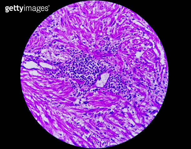 Prostate Cancer: Microscopic image of prostatic tissue, adenocarcinoma ...