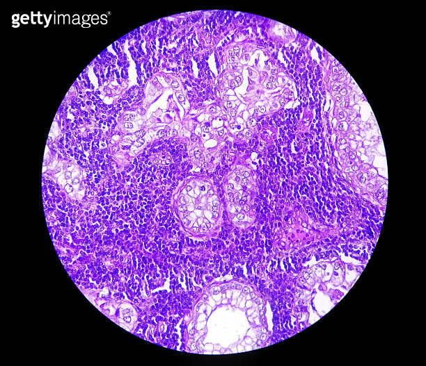 Stomach cancer: Adenocarcinoma of stomach. Close microscopic view. 이미지 ...