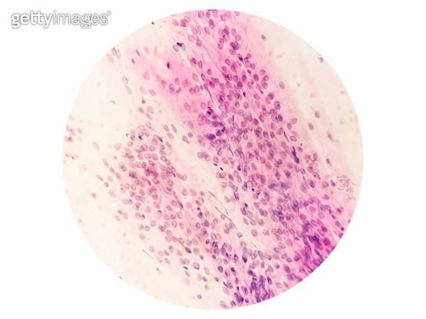 Microscopic view of Trichomonas vaginalis in pap smear with few acute ...