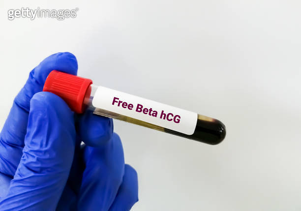 Blood sample for Free Beta hCG hormone test, health and medical concept ...