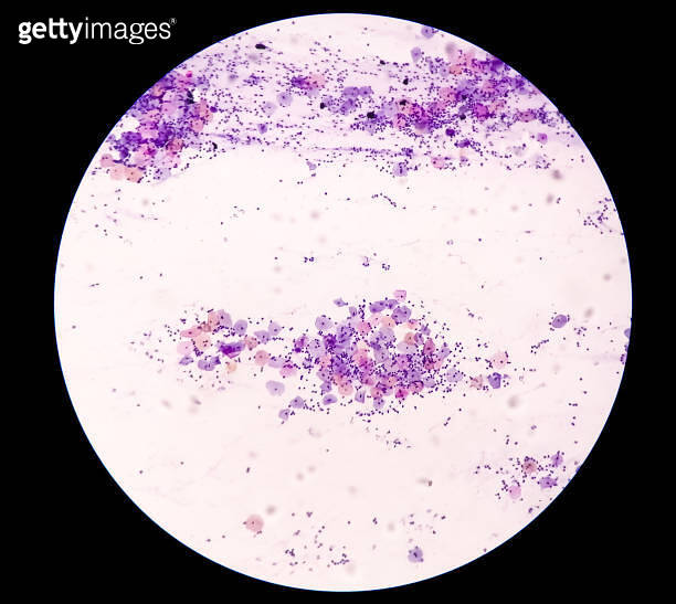Microscopic view of PAP'S smear showing severe negative for ...