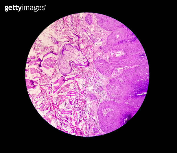 High magnification of skin cells infected with the HPV Virus. Common ...