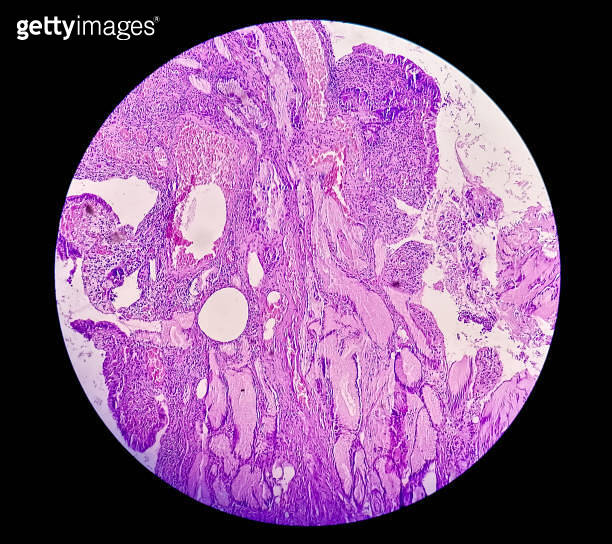 Photomicrograph of stomach tissue biopsy showing Adenomatous polyps ...