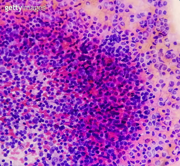 Chronic non specific lymphadenitis or CNSLA. lymphadenitis is an ...