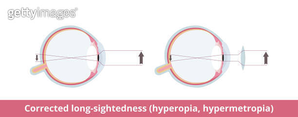 Corrected long-sightedness (hyperopia, hypermetropia) 이미지 (1413877346 ...