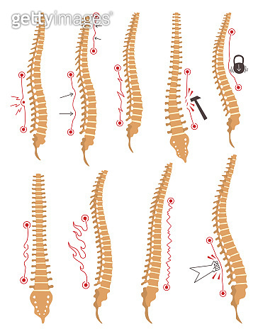 Spinal deformity types. Symbols of spine curvatures or unhealthy ...