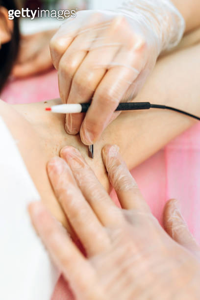 Procedure removal of hair permanently in a woman's armpits using metod ...