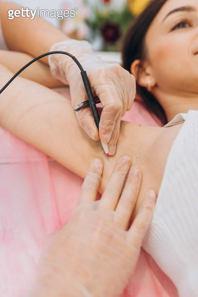 Procedure removal of hair permanently in a woman's armpits using metod ...