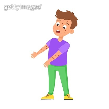 boy with large rash on his arms with signs of chickenpox disease. Cute ...