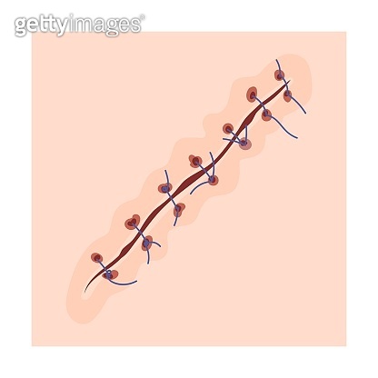 Skin scar with seam cartoon illustration. Bloody wound, injures ...