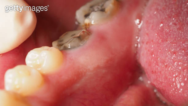 Decayed tooth root canal treatment. Tooth or teeth decay of lower molar ...