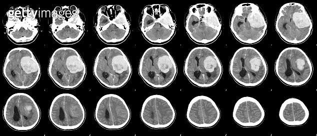 CT Brain History Headache Finding a 7 cm. extra-axial mass with stong ...