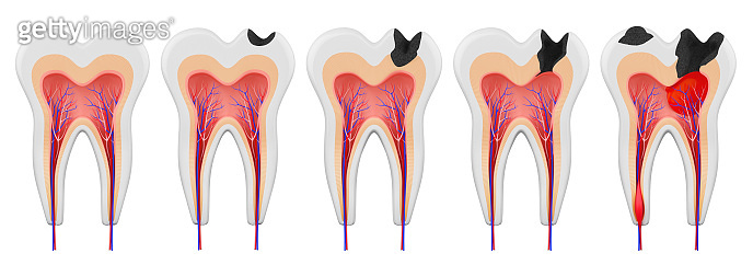 Stages of caries development in a human molar. Healthy tooth. Dental ...