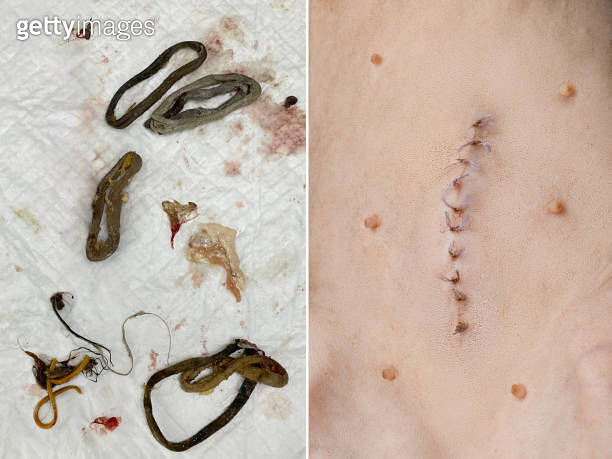 Cat Intestinal Blockage. Intestinal contents and suture scar closeup ...