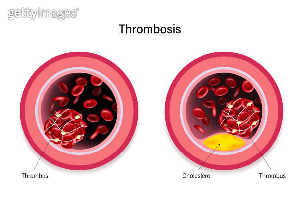 Thrombosis in blood vessel. Blood clots or thrombus block the flow of ...
