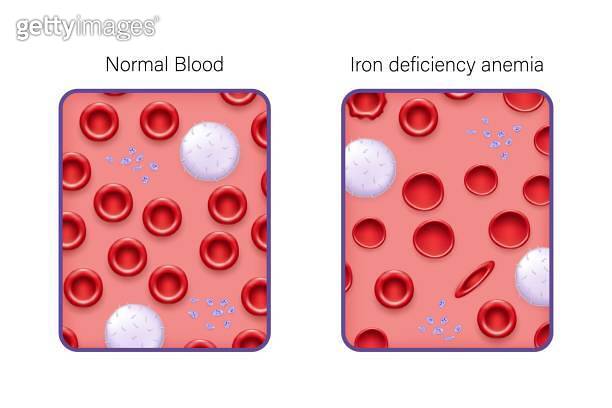 Comparison between normal blood and iron deficiency anemia vector ...