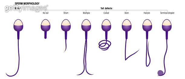 Normal and Tail defects spermatozoon. Semen analysis vector. Sperm ...