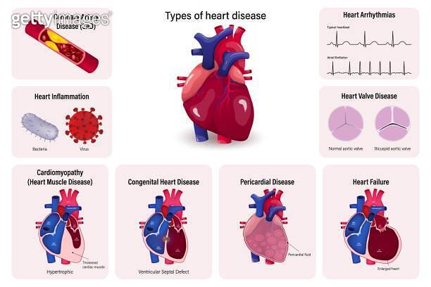 Types of heart disease vector. Coronary Artery Disease (CAD), Heart ...
