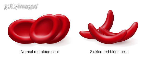 Sickle cell disease. Normal red blood cells and sickled red blood cells ...