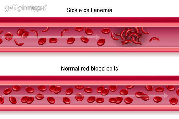 Diagram of comparison Blood flow between sickle cell disease and normal ... Diagram of comparison Blood flow between sickle cell disease and normal ...