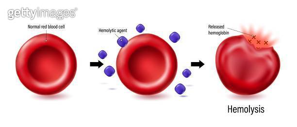 Hemolysis vector. The process of red blood cell destruction. Normal red blood cell with ...